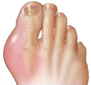 Gicht: Ursachen, Folgen, Behandlung | A.Vogel